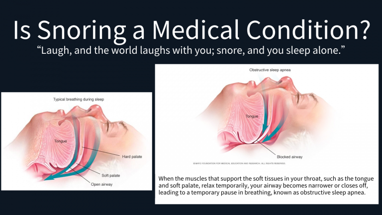 Is Snoring a Medical Condition? - SLEEPON