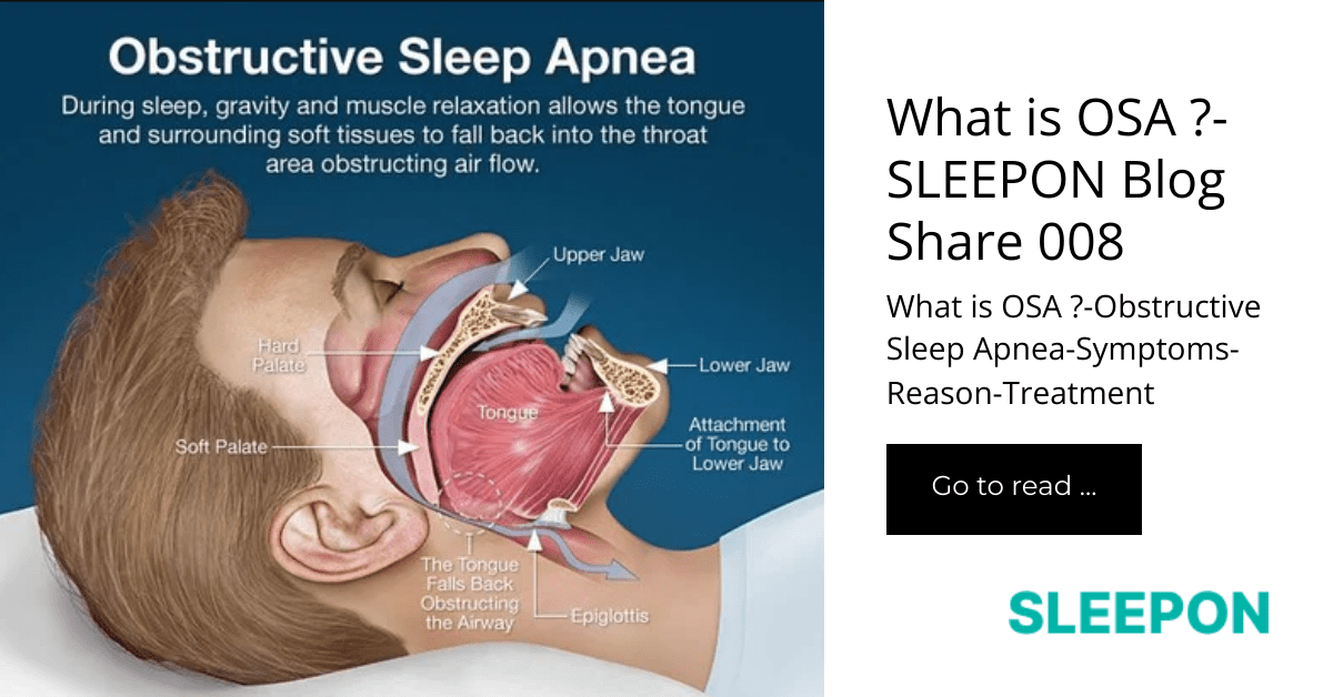 What is OSA ?-Obstructive Sleep Apnea-Symptoms-Reason-Treatment - SLEEPON SLEEPON