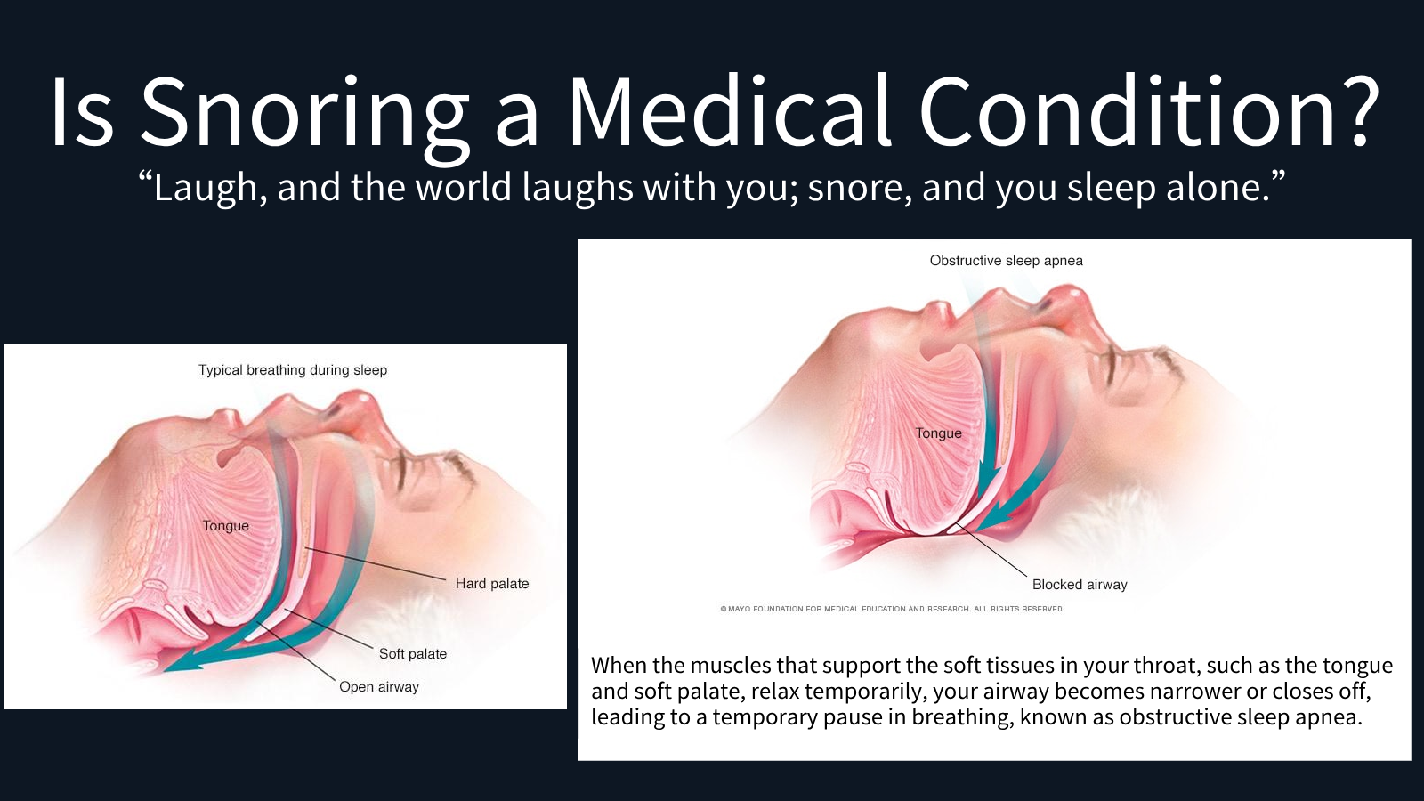 Is Snoring a Medical Condition? - SLEEPON